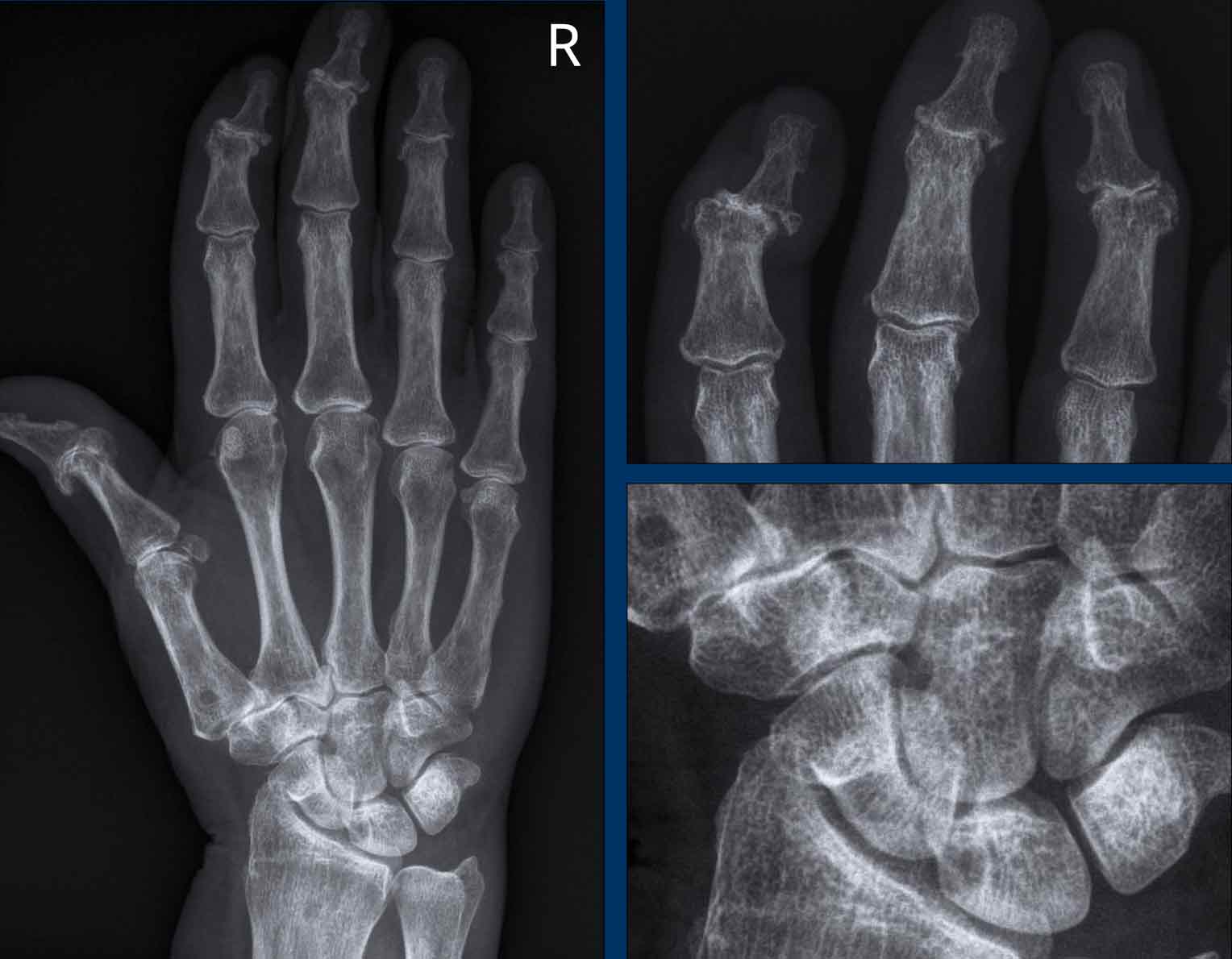 The Radiology Assistant : Arthritis