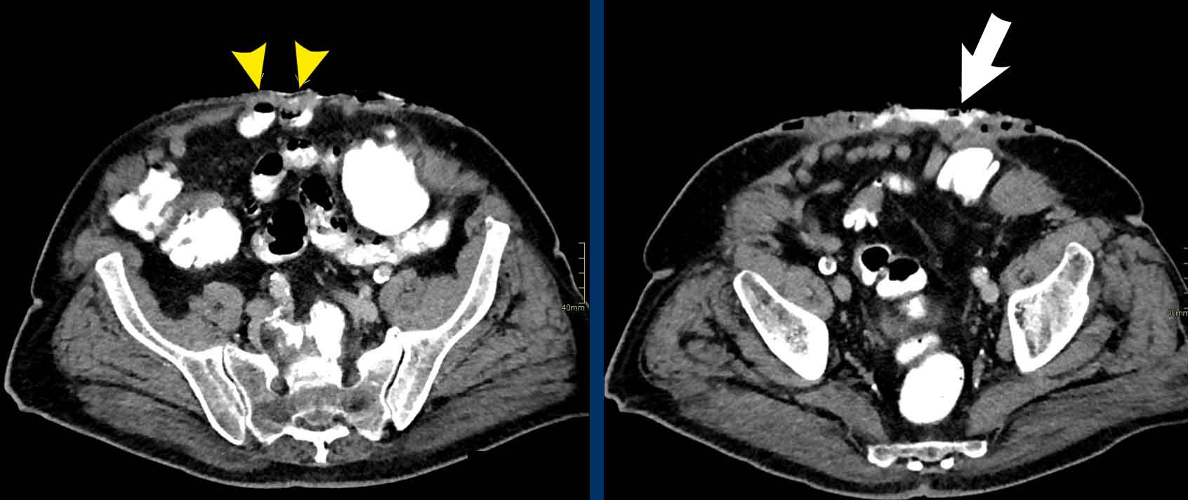The Radiology Assistant : Abdominal wall hernias