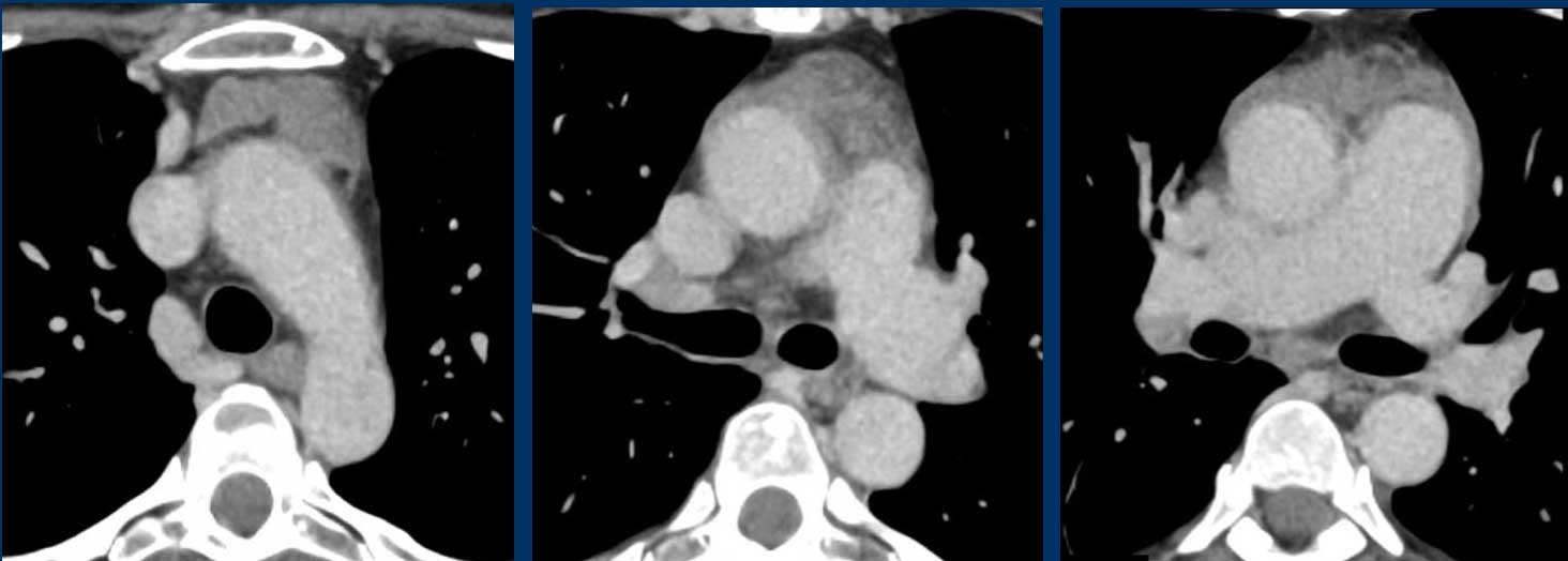 The Radiology Assistant : Thymic masses and mimics