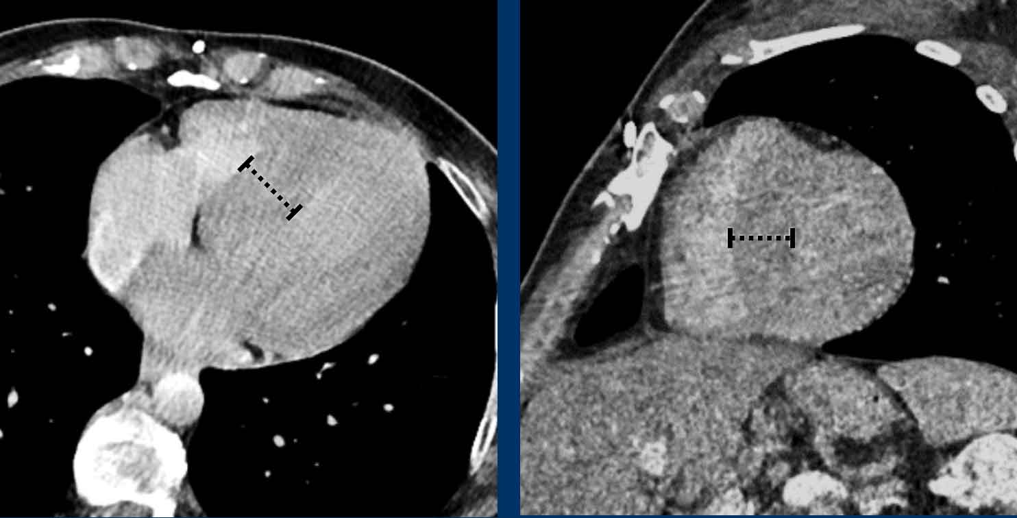 The Radiology Assistant : Cardiovascular Pearls on Chest CT...