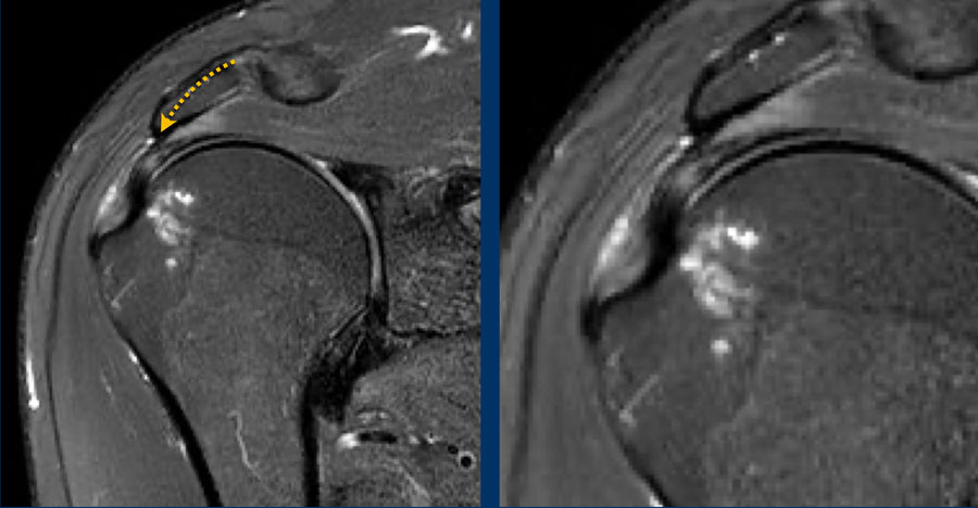 The Radiology Assistant : Shoulder Rotator cuff injury