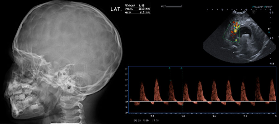 The Radiology Assistant : Craniosynostosis