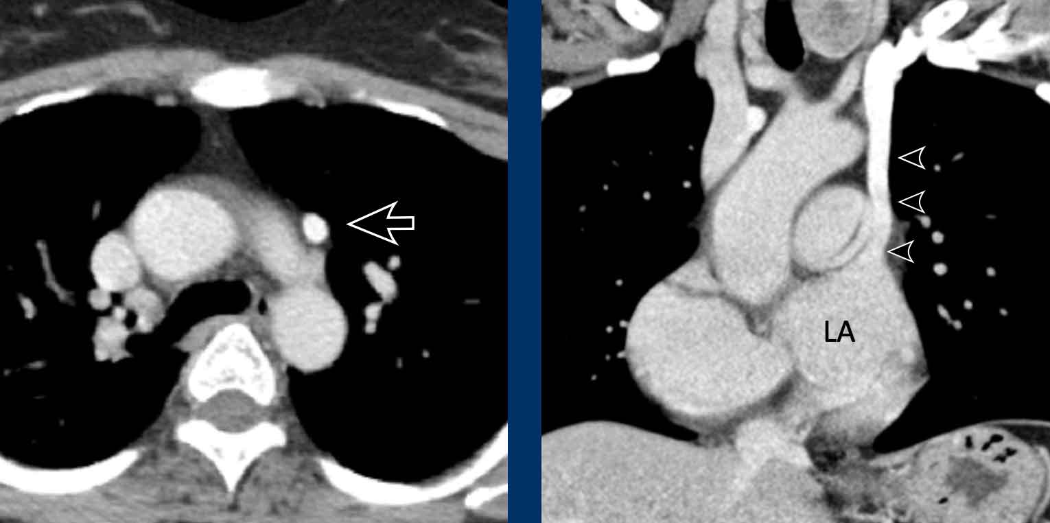 The Radiology Assistant : Cardiovascular Pearls on Chest CT...