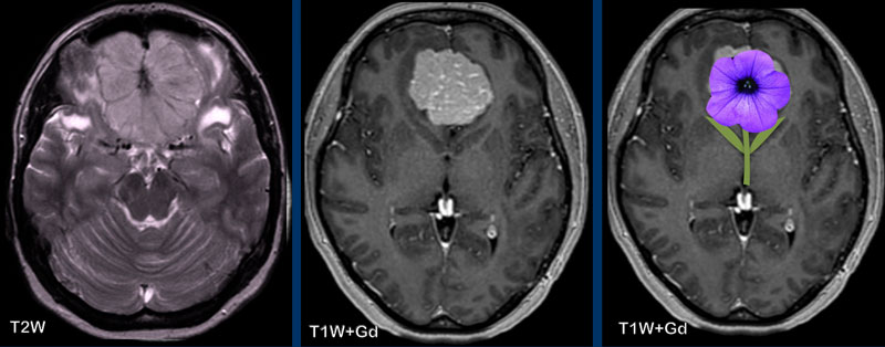 The Radiology Assistant : Enhancement Patterns in CNS disease