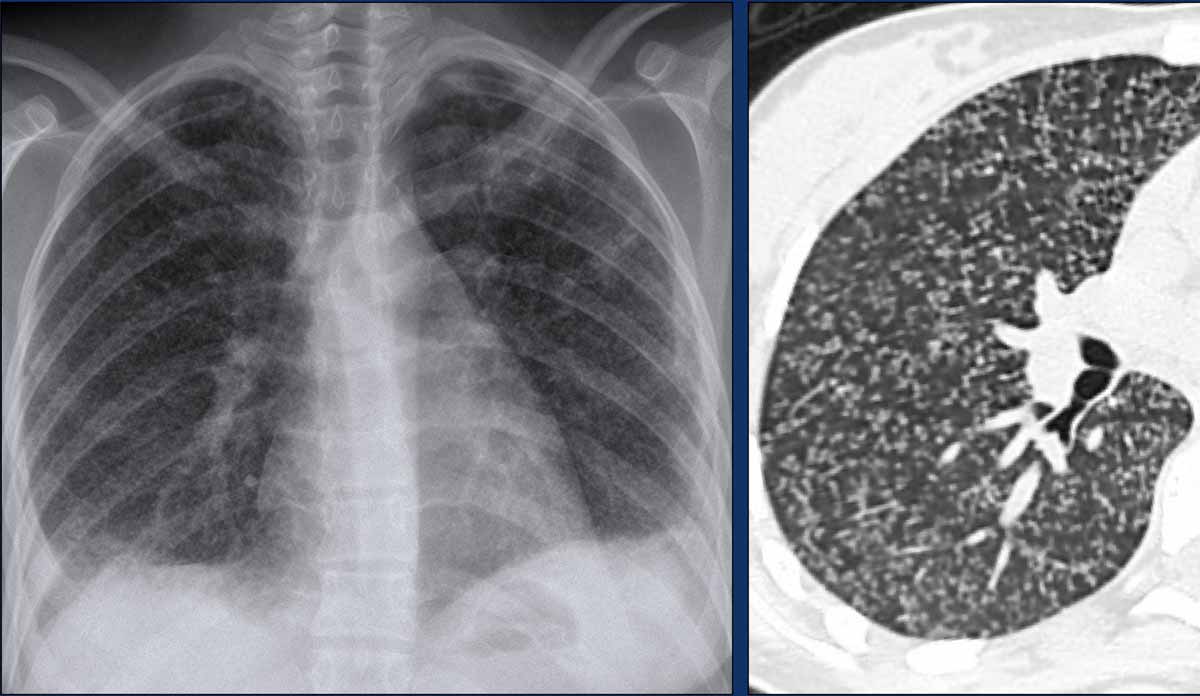 The Radiology Assistant : Imaging findings in TB