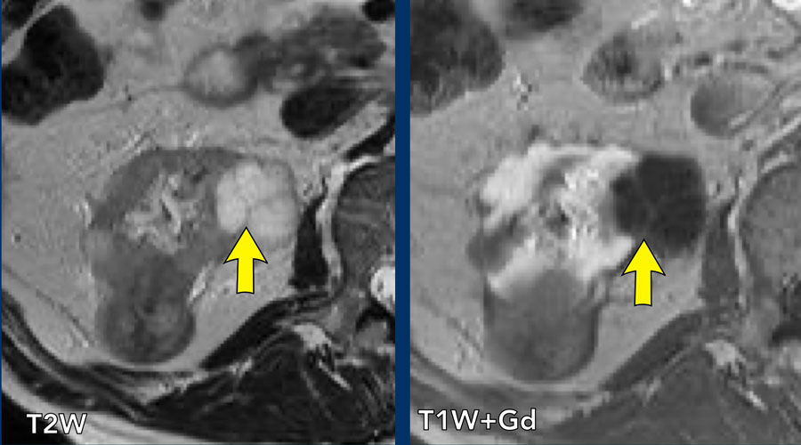 The Radiology Assistant : Bosniak Classification 2019