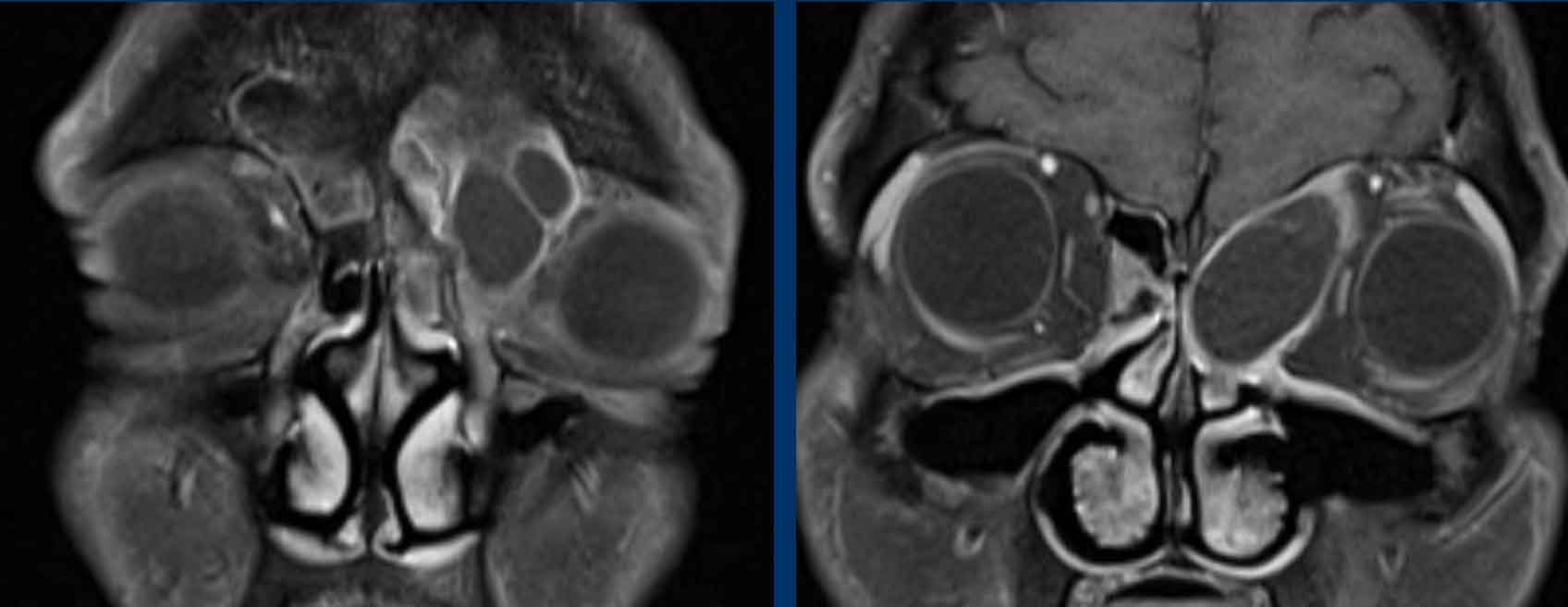 The Radiology Assistant : Head Neck tumors - When to think of malignancy