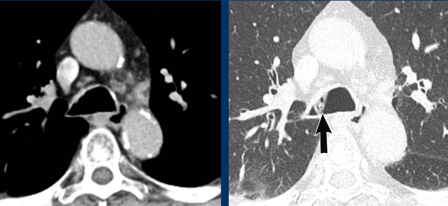 The Radiology Assistant : Large airway disease