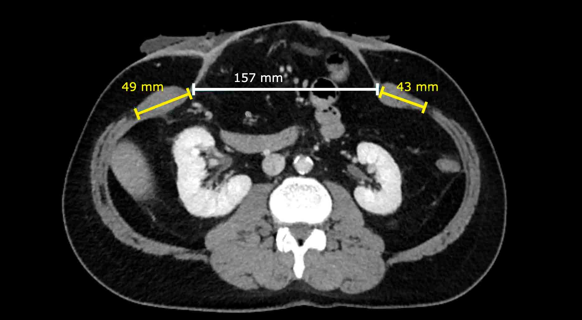 The Radiology Assistant : Abdominal wall hernias