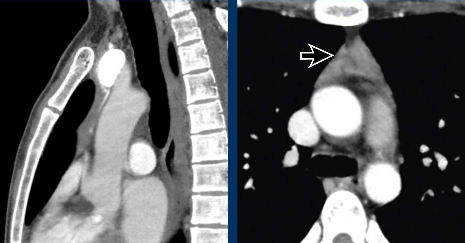 The Radiology Assistant : Thymic masses and mimics
