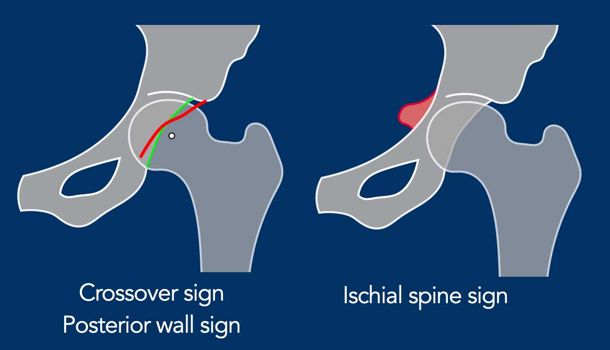 The Radiology Assistant : Femoroacetabular impingement syndrome