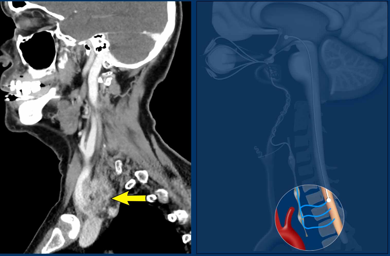 The Radiology Assistant : Horner syndrome