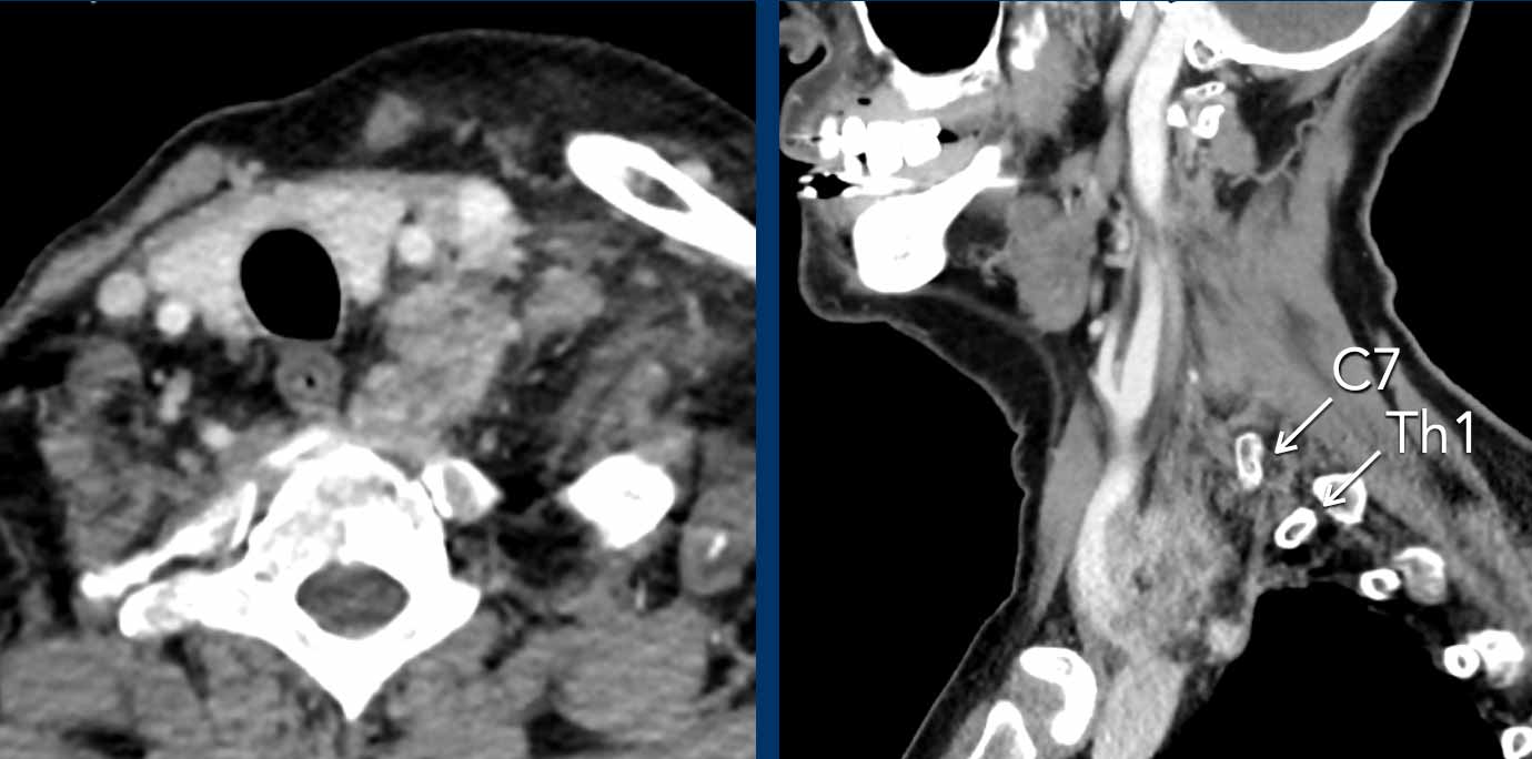 The Radiology Assistant : Horner syndrome.