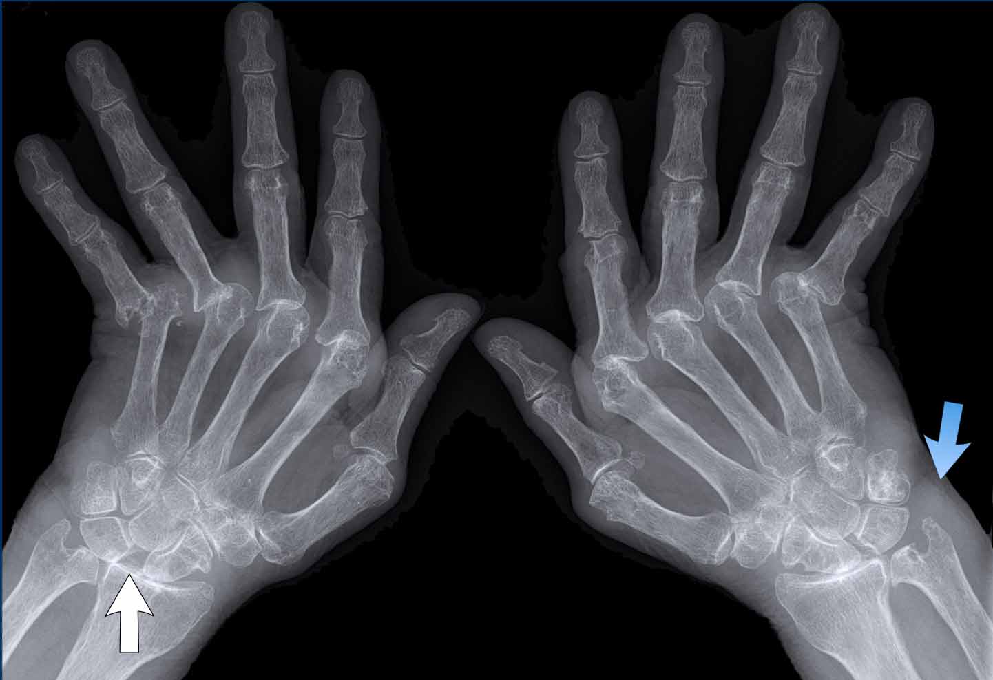 The Radiology Assistant : Arthritis