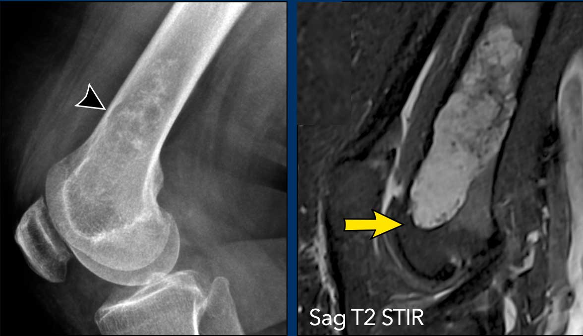 The Radiology Assistant : Cartilage tumors