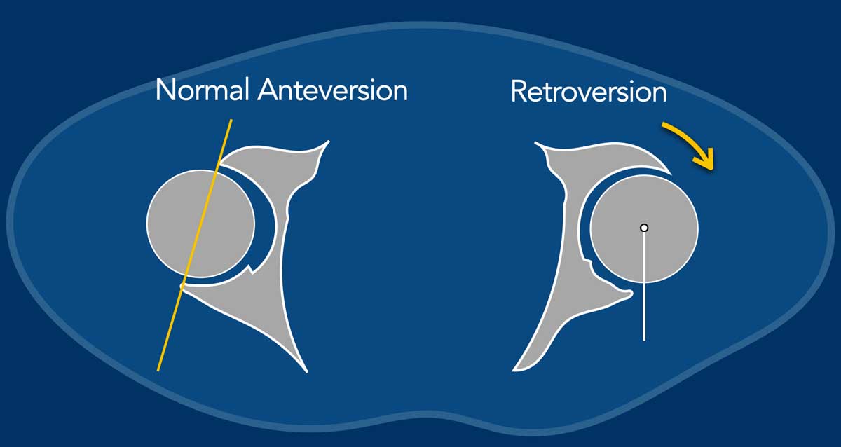 The Radiology Assistant : Femoroacetabular impingement syndrome