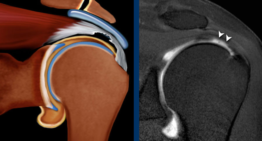 The Radiology Assistant : Shoulder - Rotator cuff injury
