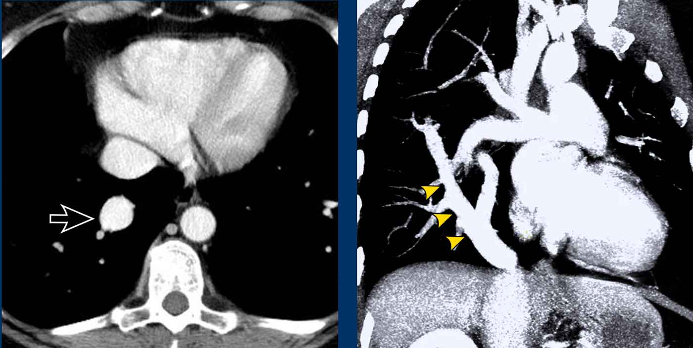 The Radiology Assistant : Cardiovascular Pearls on Chest CT...