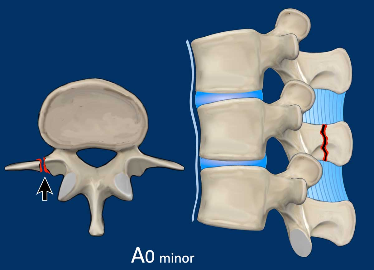 The Radiology Assistant : AO Spine Classification of Thoracolumbar ...