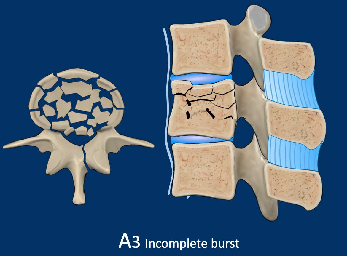 The Radiology Assistant : AO Spine Classification of Thoracolumbar Fractures