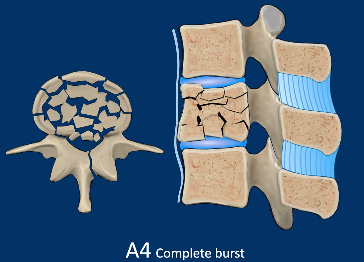 The Radiology Assistant : AO Spine Classification of Thoracolumbar ...