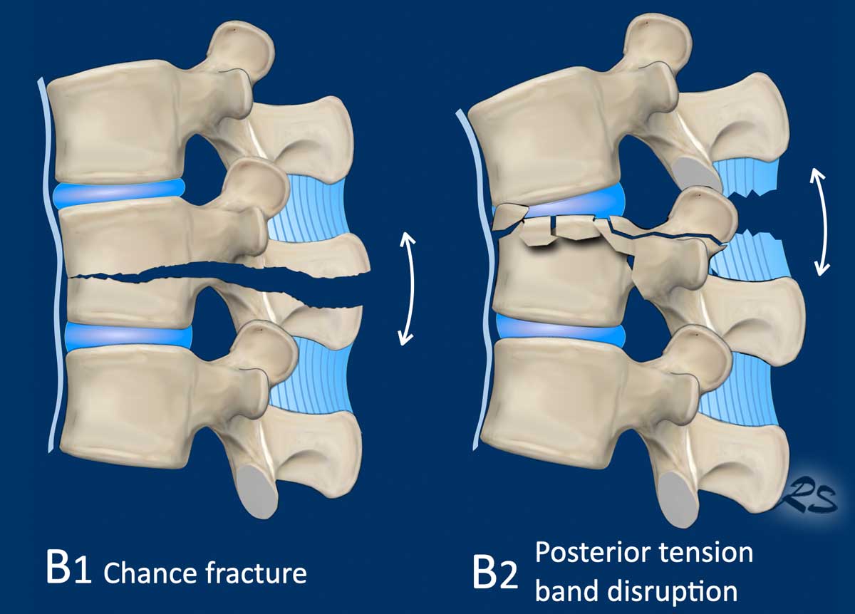 The Radiology Assistant : AO Spine Classification of Thoracolumbar ...