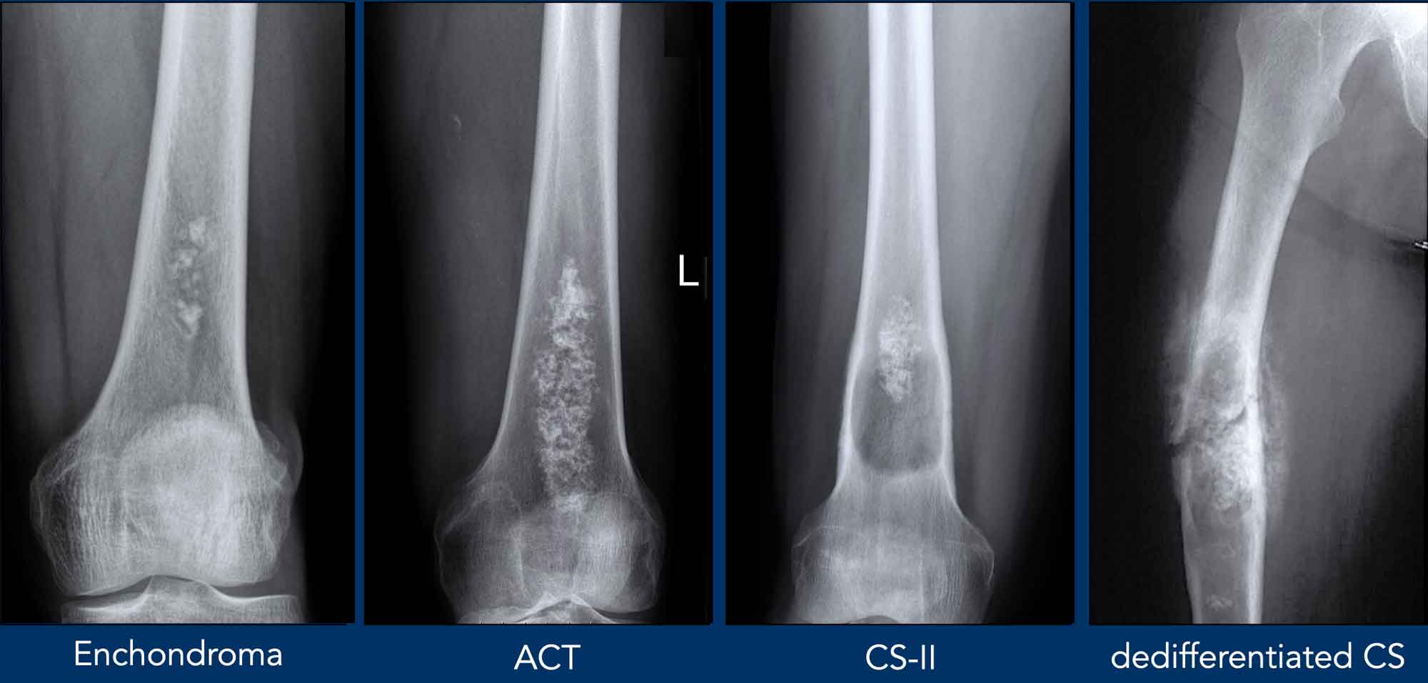 The Radiology Assistant : Cartilage tumors