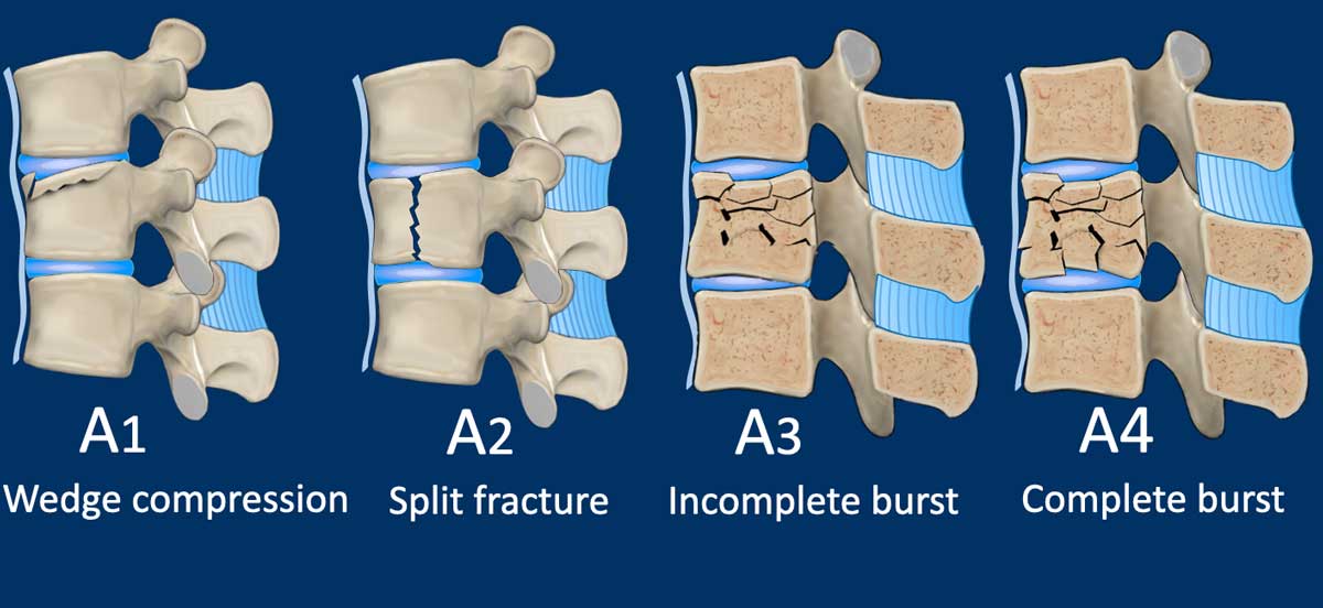 The Radiology Assistant : AO Spine Classification of Thoracolumbar ...