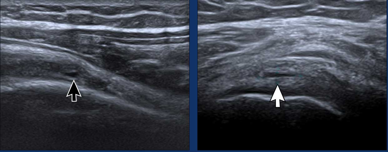 The Radiology Assistant : Shoulder Ultrasound