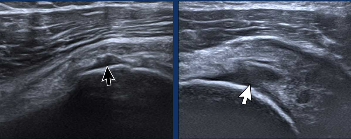 The Radiology Assistant : Shoulder Ultrasound