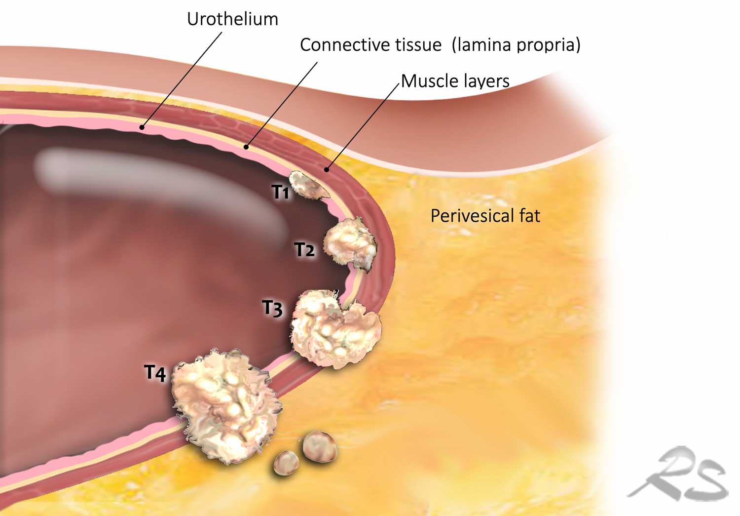 The Radiology Assistant : Bladder Cancer - VI-RADS