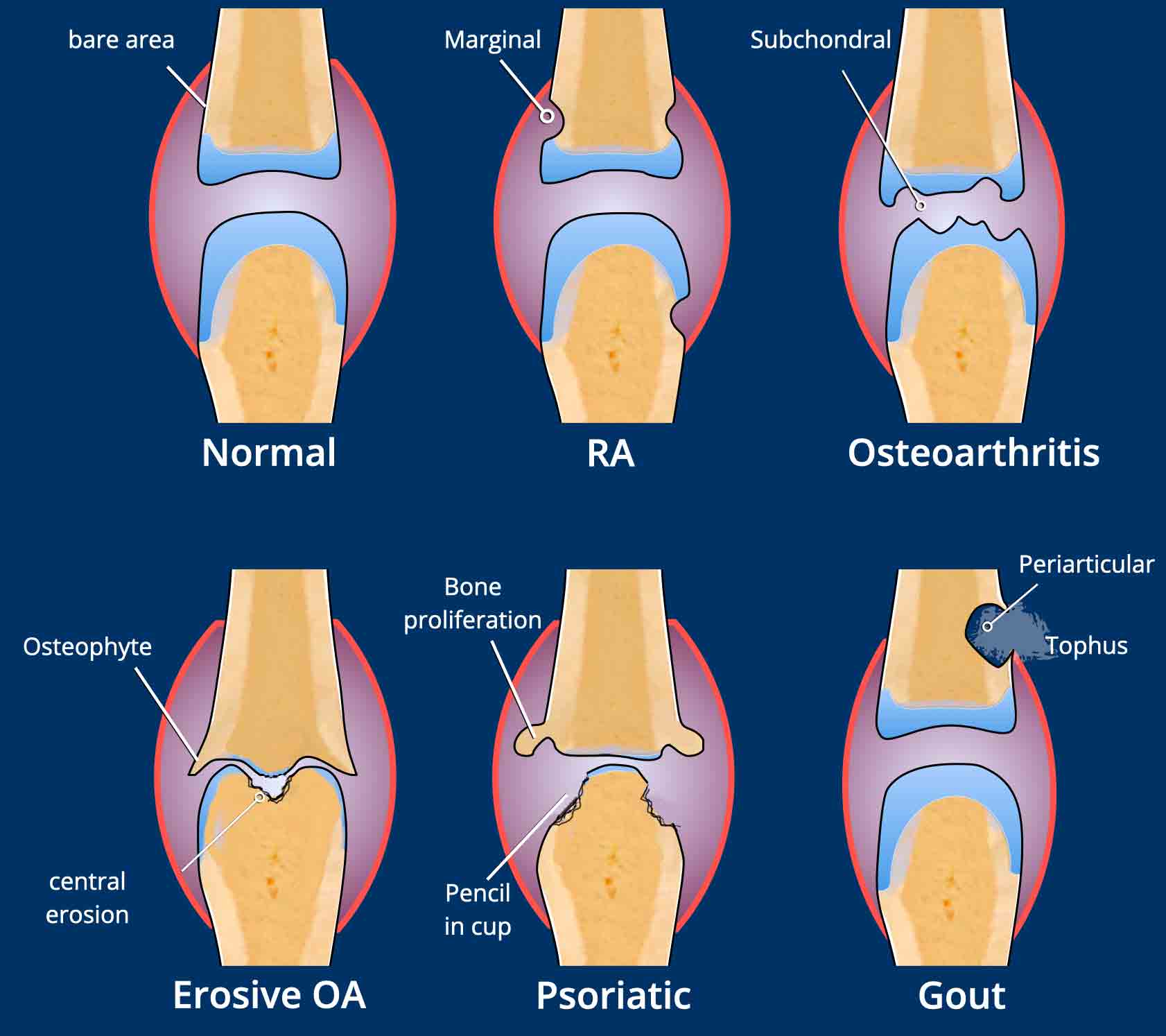 The Radiology Assistant : Arthritis