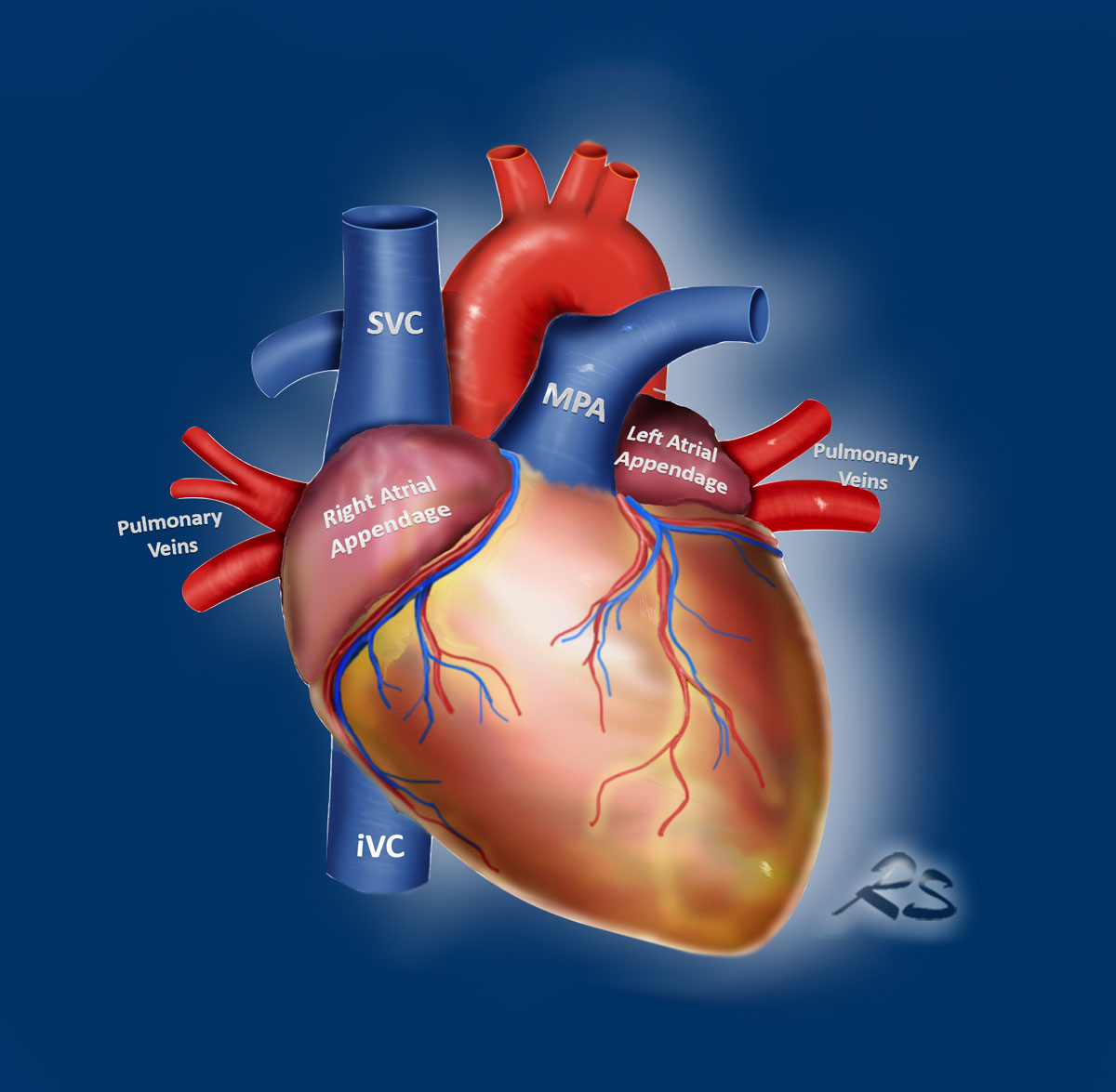 The Radiology Assistant : Cardiovascular Pearls on Chest CT.