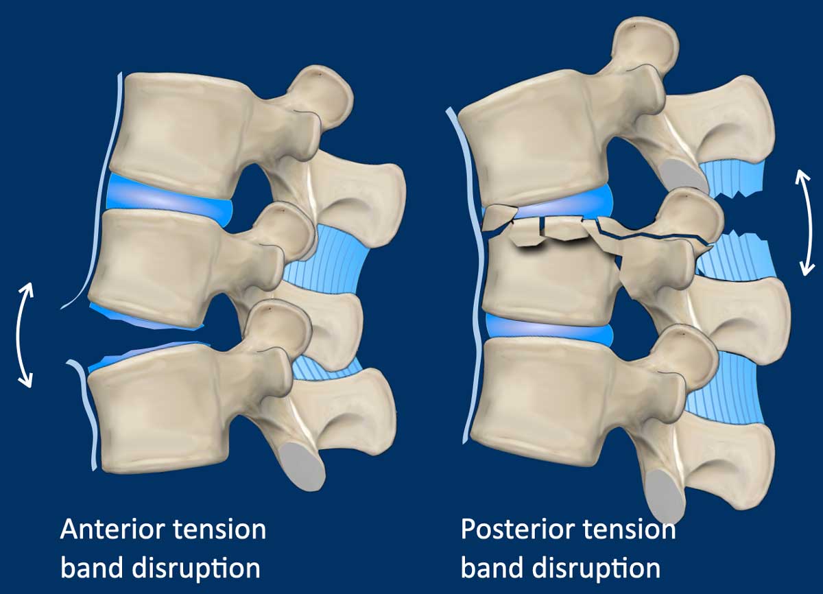 The Radiology Assistant : AO Spine Classification of Thoracolumbar ...