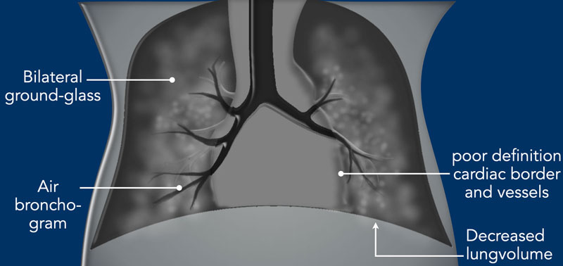 The Radiology Assistant : Neonatal Chest X-Ray