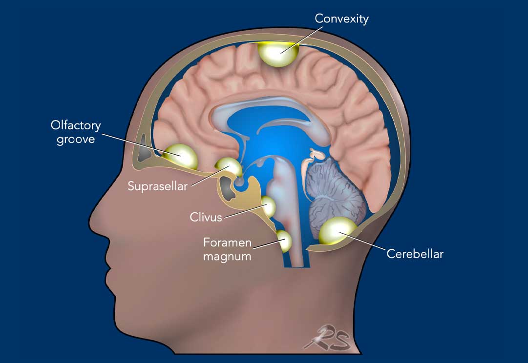 The Radiology Assistant : Enhancement Patterns in CNS disease