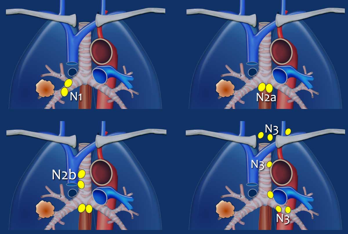 The Radiology Assistant : TNM classification 9ᵗʰ edition