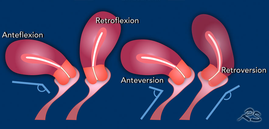 The Radiology Assistant : Endometrial Cancer - MR staging