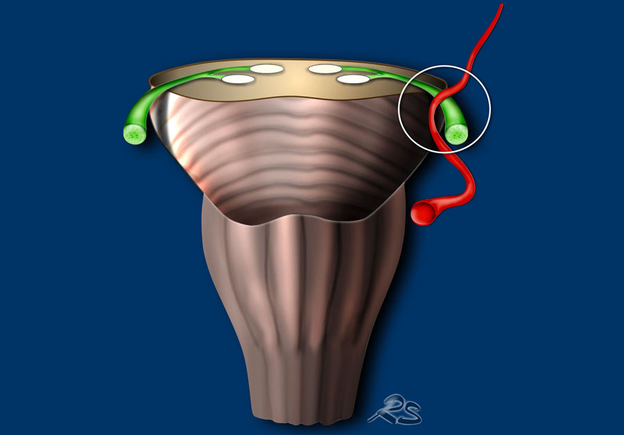 The Radiology Assistant : Trigeminal neuralgia