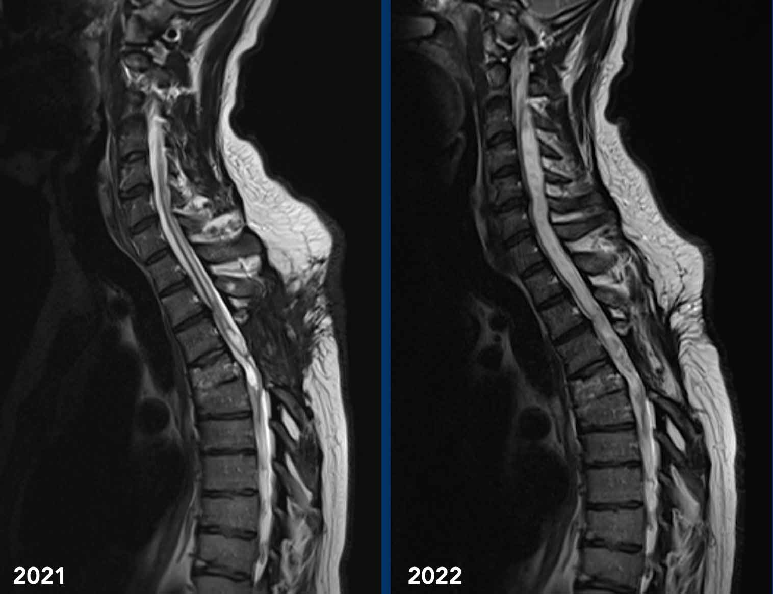 The Radiology Assistant : Horner syndrome