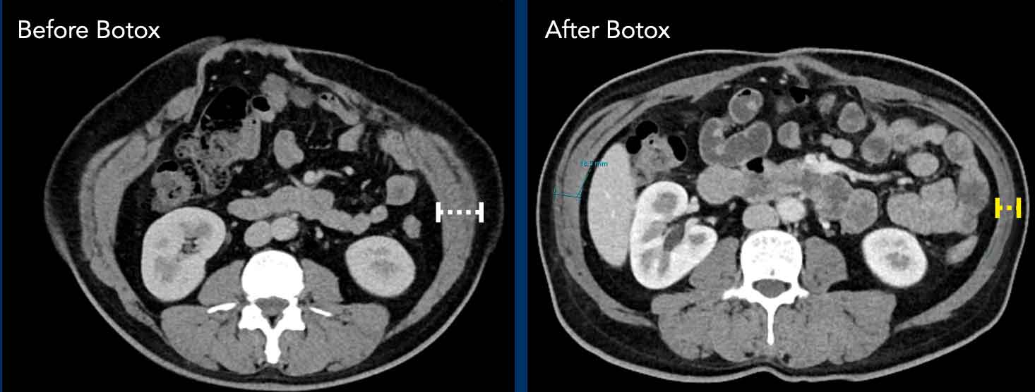The Radiology Assistant : Abdominal wall hernias