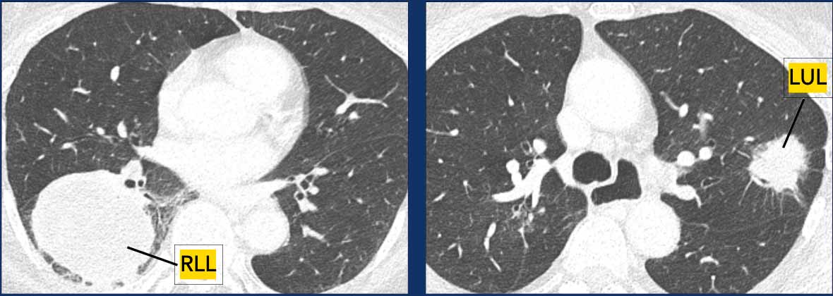 The Radiology Assistant : TNM classification 9ᵗʰ edition