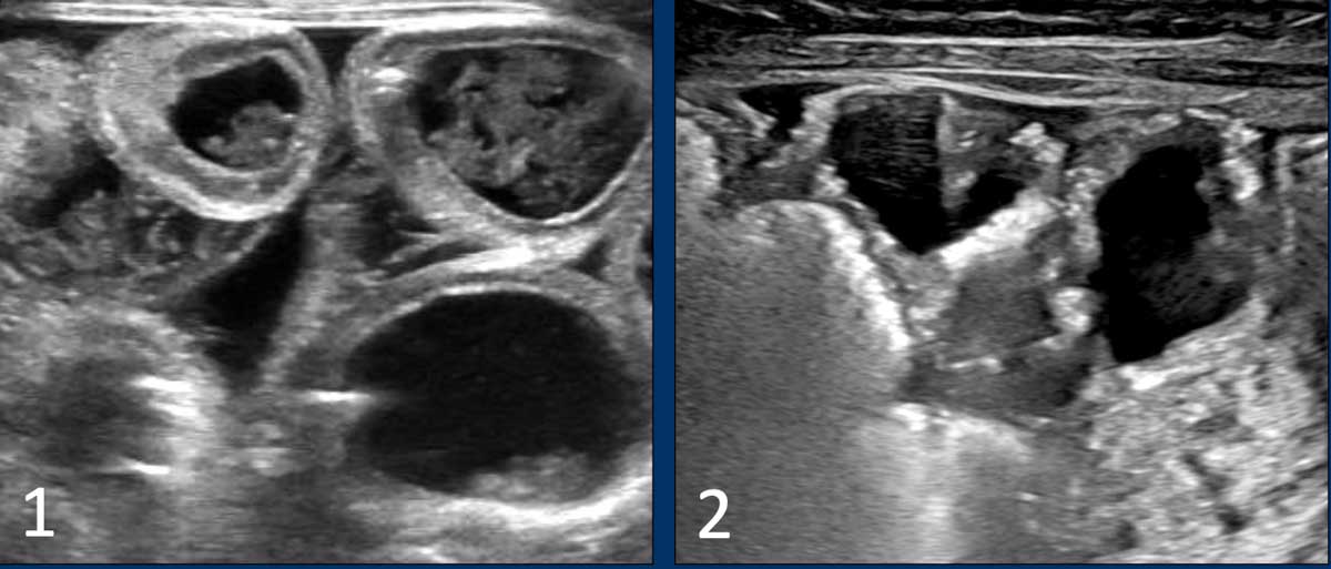The Radiology Assistant : Necrotizing Enterocolitis
