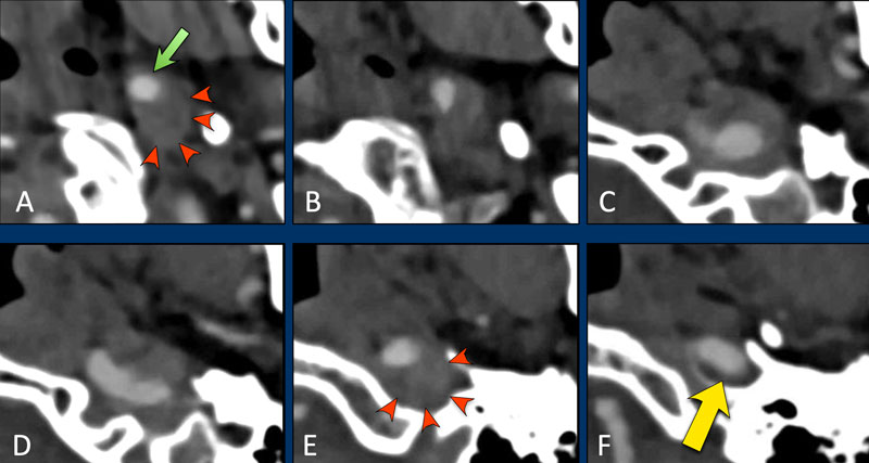 The Radiology Assistant : How to Differentiate Carotid Obstructions