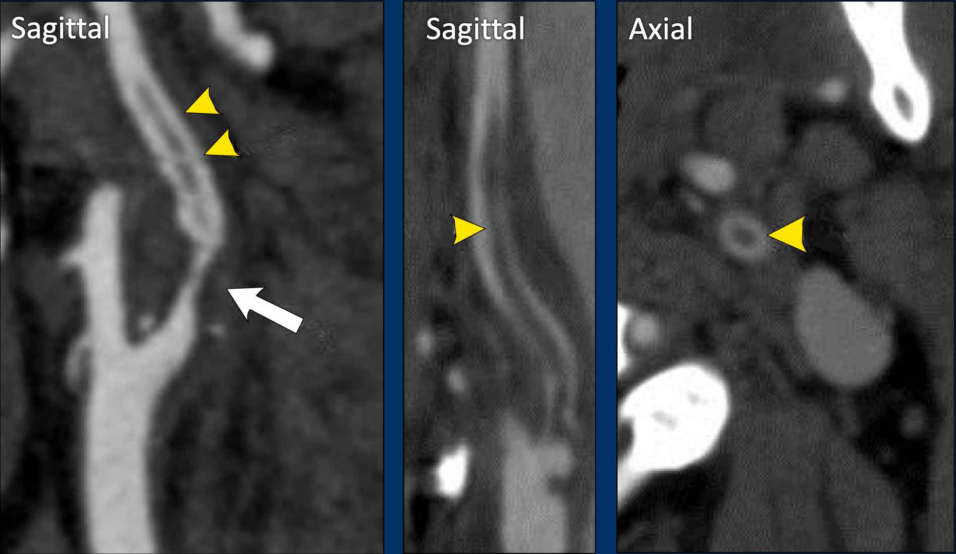 The Radiology Assistant : How to Differentiate Carotid Obstructions