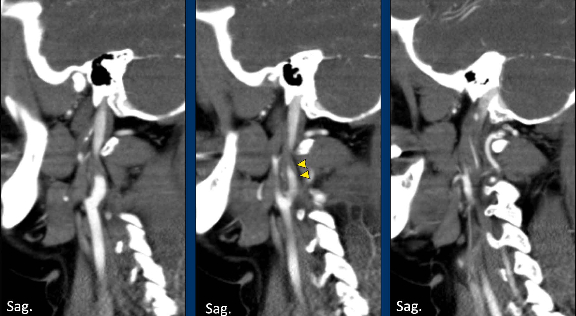 The Radiology Assistant : How to Differentiate Carotid Obstructions