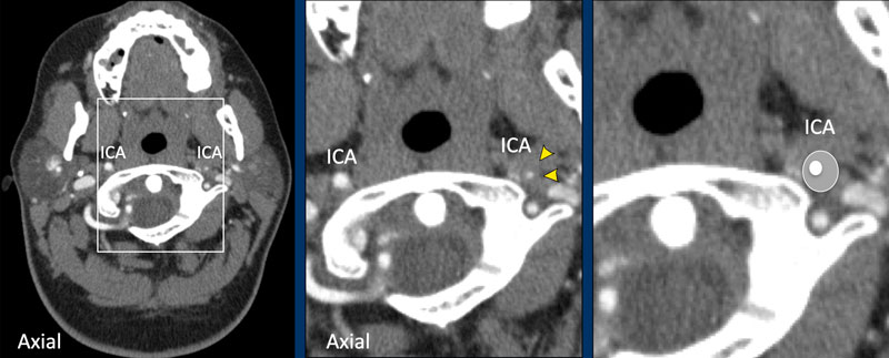 The Radiology Assistant : How to Differentiate Carotid Obstructions