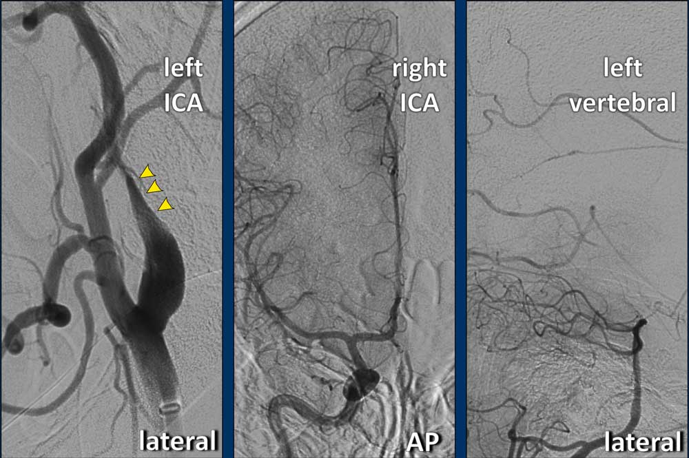 The Radiology Assistant : How to Differentiate Carotid Obstructions