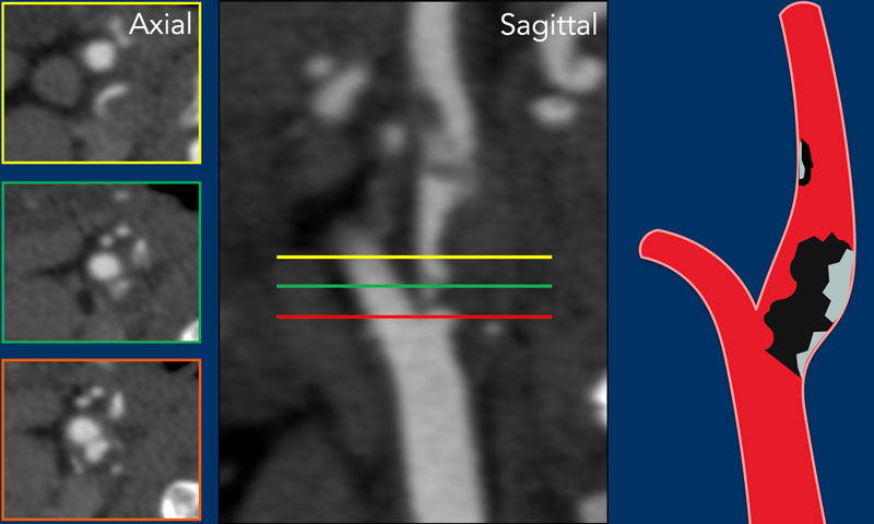 The Radiology Assistant : How to Differentiate Carotid Obstructions