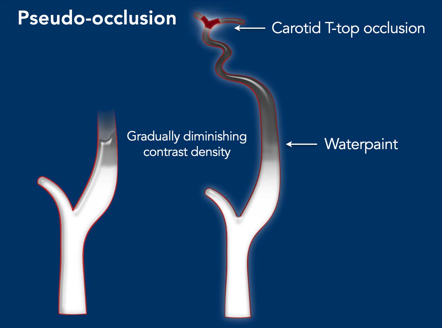 The Radiology Assistant : How to Differentiate Carotid Obstructions
